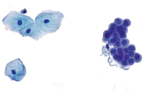 Urine Cytopathology Libre Pathology