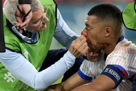 Football Équipe de France Kylian Mbappé s est cassé le nez contre l