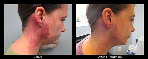 Port Wine Stain Before And After