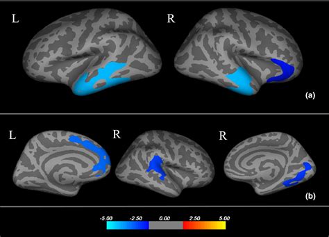Cortical Thickness And Subcortical Structure Volume Abnormalities In