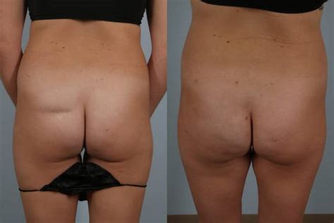 Fat Grafting BBL Case 1854 Scott Spiro MD