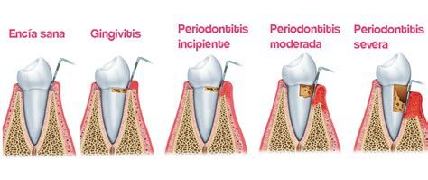 Qué es la periodontitis y cómo tratarla