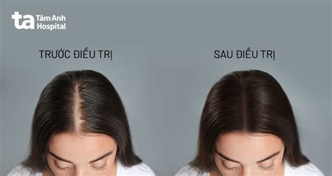 Rụng Tóc Nhiều Ở Nữ Là Bệnh Gì Nguyên Nhân Cách Điều Trị Hiệu Quả