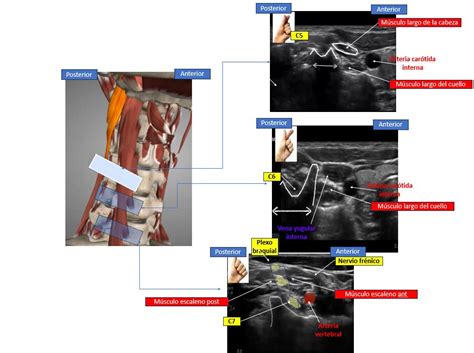 Ecograf A De La Columna Vertebral Cervical Dolopedia