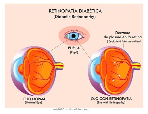 Retinopatía diabética síntomas complicaciones y diagnóstico