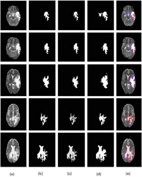 brain tumor segmentation results based on the hybrid technique of download scientific diagram