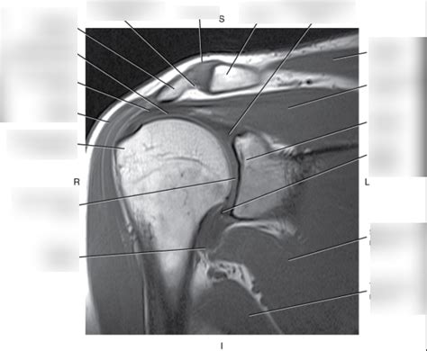 Coronal Shoulder Diagram Quizlet
