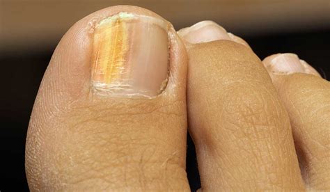 prevención de hongos en las uñas de los pies Archivos Revista