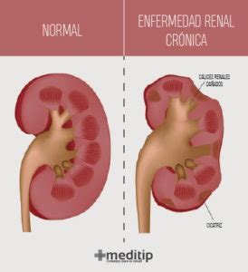 Enfermedad renal crónica causas diagnóstico y tratamiento