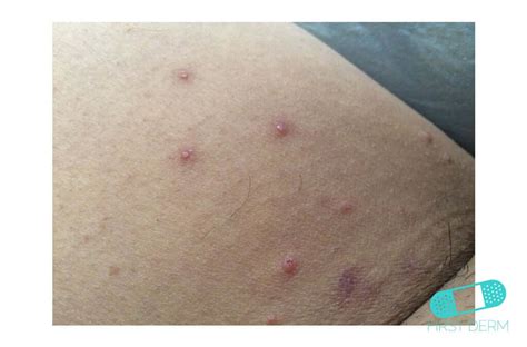 Molluscum Contagiosum Water Warts Online Dermatology