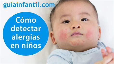Cuales son las señales de las alergias de la piel en un bebé