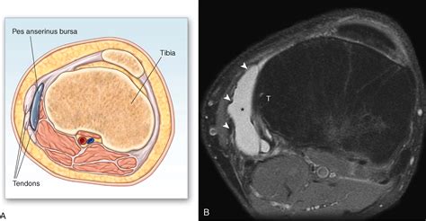 Pes Anserinus Bursa Injection Clinical Tree