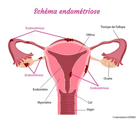 Programme d accompagnement de l endométriose endOnaturel