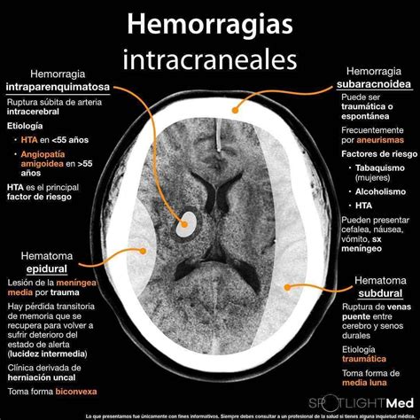 Diagrama De Las Partes Del Cerebro Diagrama Que Muestra La Hemorragia