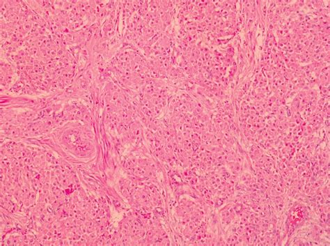 Histological Section Of Leydig Cell Tumor In The Right Testis The