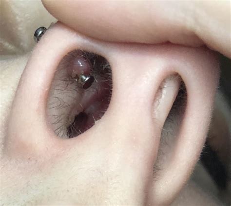 List Pictures Keloid Nose Piercing Healing Process Pictures Full Hd