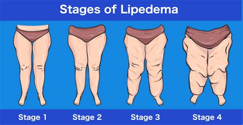 Types And Stages Of Lipedema Lipedema Grau Plantecuador