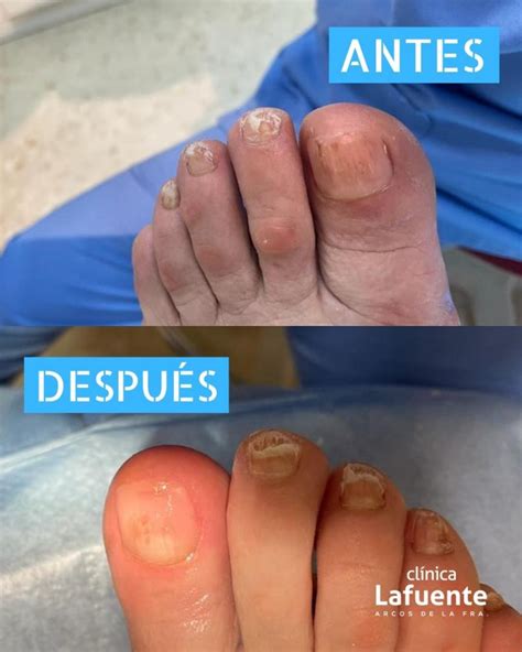 Reconstrucción de uñas Qué es y en qué casos se usa Clínica