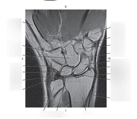 FIG 9 125 Coronal T2 Weighted MRI Of Wrist With Triangular