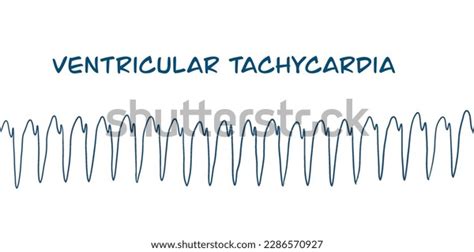 Ecg Example Monomorphic Vt Stock Illustration 2286570927 Shutterstock