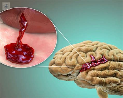 Hemorragia Cerebral Causas síntomas y tratamiento Top Doctors