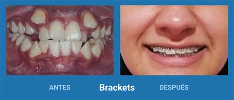 Brackets Opciones Tratamiento Precios Y Duraci N