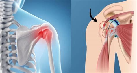 Ombro O Que S Ndrome Do Impacto Equil Brio Fisioterapia Campo Belo