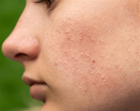 Cuáles Son Los Principales Tipos de Granos en el Cuerpo NIVEA