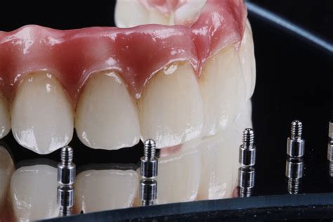 Prótese em Zircônia Implantes Dentais Douglas Lima