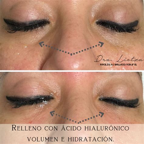 Resultados Antes y Después de Rellenos Faciales con Ácido Hialurónico