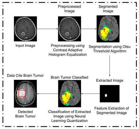 Healthcare Free Full Text Earlier Detection Of Brain Tumor By Pre