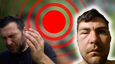 What They Don T Tell You About Bee Stings Youtube