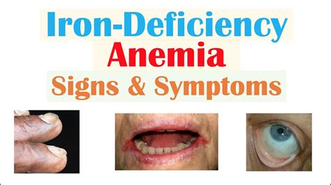 Iron Deficiency Anaemia Symptoms Signs You Have An Iron Deficiency