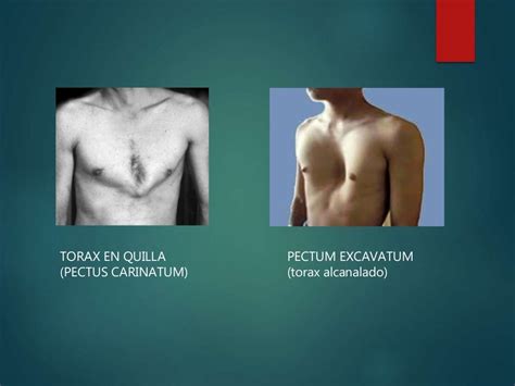 Tipos De Torax