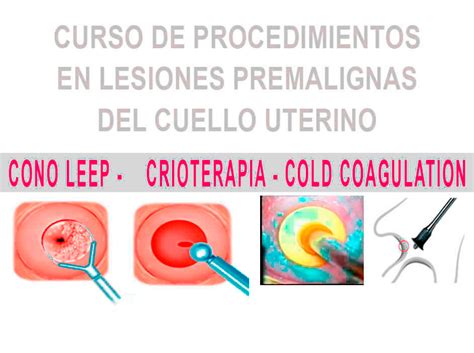 Curso T Cnica De Manejo Lesiones Premalignas Cuello Uterino Portal De