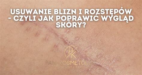 Usuwanie blizn i rozstępów czyli jak poprawić wygląd skóry Pani