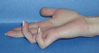 Ulnar Nerve Injury Cause Symptom Treatment Exercise