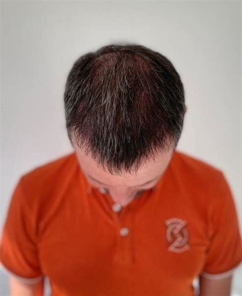 Après la greffe de cheveux L évolution mois par mois de la repousse