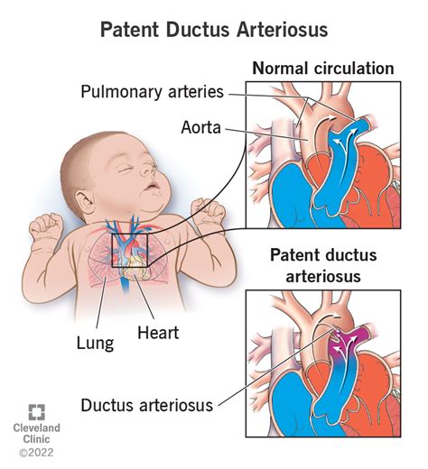 Patent Ductus Arteriosus PDA Tünetek és kezelés Orvos 24