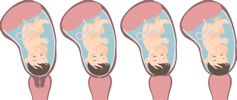 Hình ảnh cổ tử cung khi mang thai Nguy cơ sinh non khi cổ tử cung ngắn