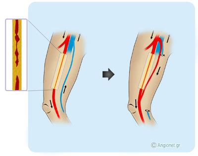 Arterial Bypass Surgery