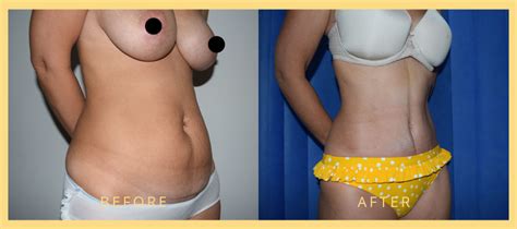 Tummy Tuck Before And After Results Hr Plastic Surgery