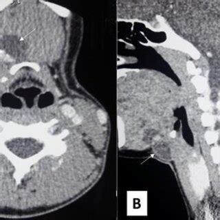 Axial A And Sagittal B With Contrast Enhanced Computed Tomography