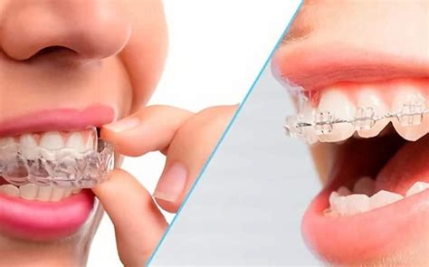 Ofrece Invisalign Buenos Resultados Como Los Brackets Ferrus Bratos
