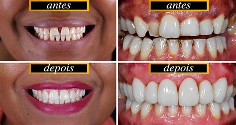 Lente de Contacto Dental Vantagens e Resultados Clínica Dentária
