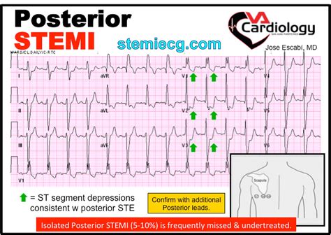 Mastering Stemi Ecg