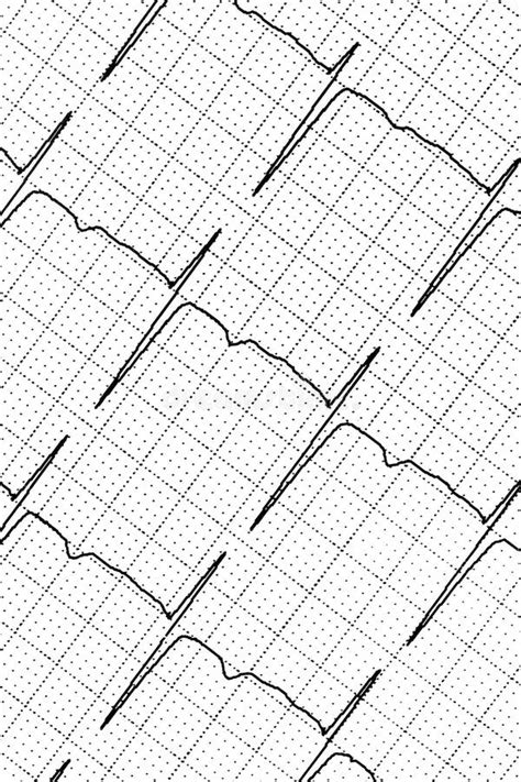 Prueba Del Electrocardiograma Que Muestra La Actividad Eléctrica Del