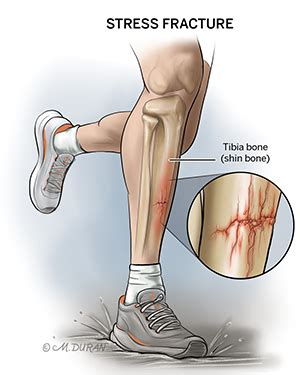 Ut Health Austin Fractures