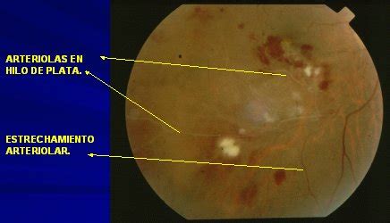 Compromiso ocular en la hipertensión arterial Medwave