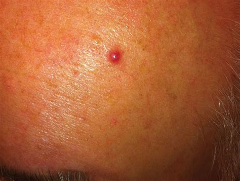 Merkel Cell Cancer Images Merkel Cell Carcinoma Merkel Cell